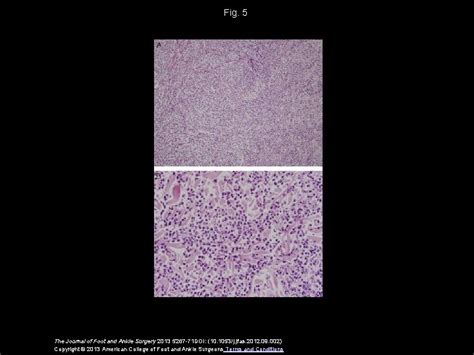 Pyoderma Gangrenosum Mimicking A Diabetic Foot Infection A