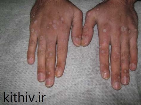 همه علائم پوستی ایدز همراه با عکس تصویر کیت Hiv