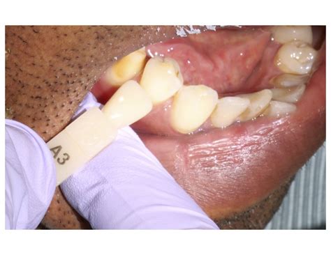 How Long Does PVS Impression Last Babe Doctor Network