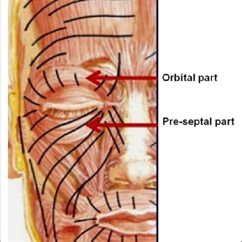 Superficial Musculoaponeurotic System Smas Showing Spread Of Spasm