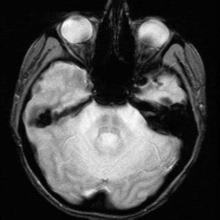 Flair Mri Brain Images Show Faint Hot Cross Bun Sign In Pons A With