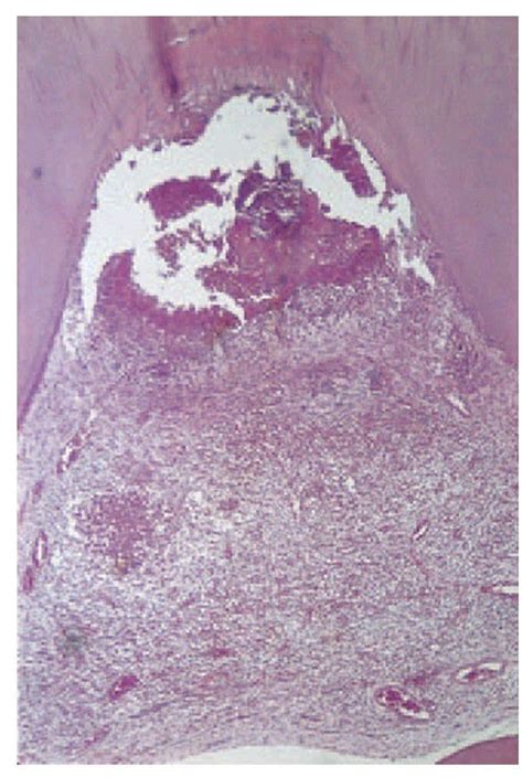 Acute Caries And Pulpitis Medizzy