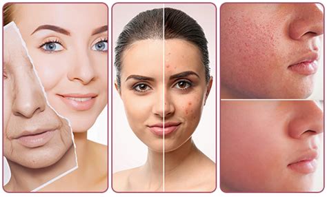 Mnrf Micro Needling Rf Dr Sajjas Clinic In Tirupati