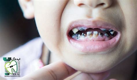 دندان خراب کودکان علت و درمان پوسیدگی دندان کودکان