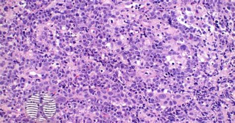 Primary Cutaneous Diffuse Large B Cell Lymphoma Pathology Image