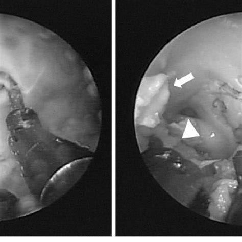 Photographs Of Procedures 2 And 3 Septostomy Left Septostomy In The