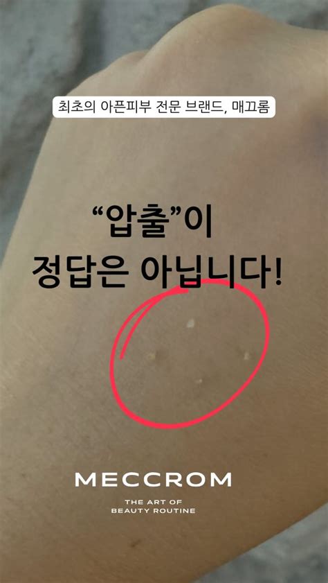 매끄롬 포항효자점 은영리더 포항피부관리 포항문제성피부 포항아픈피부 포항바디관리 설날에 살 찌신 분 손👋 저요 저요 급찐급빠 매끄롬에서 도와드릴께요😉 급찐급빠