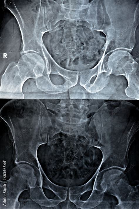 Stock Foto „plain X Ray Of Both Hip Joints Revealed Slight Narrowing Of