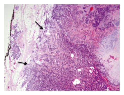 Low Power Microscopic Sections Show Areas Of Typical Pleomorphic