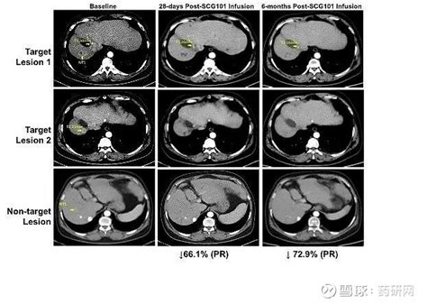 星汉德生物公布tcr T疗法最新临床数据 6月5日，星汉德生物在法国巴黎举行的国际细胞与基因治疗大会 Isct 上报告了其首创自体hbsag特异性tcr T疗法 雪球