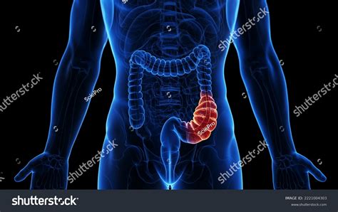 3d Rendered Medical Illustration Constipated Colon Stock Illustration
