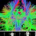 The Diffusion Tensor And Its Relation To FA MD AD And RD Diffusion Imaging Introduction