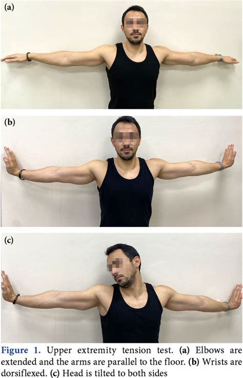 Pectoralis Minor Syndrome Pmc