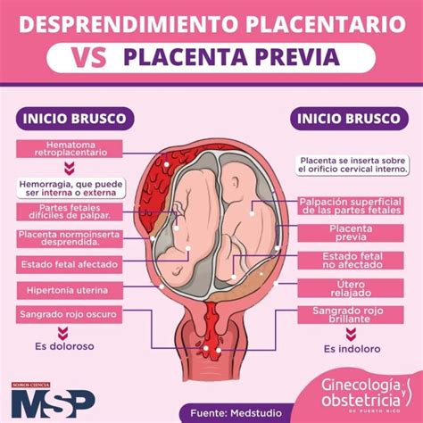 Tipos De Desprendimiento De Placenta