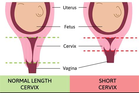 Short Cervix Length Miscarriage Double Antai Cervical Ring Procedure Antai Hospital Antai