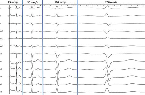Electrophysiology Study Interpretation Of Intracardiac