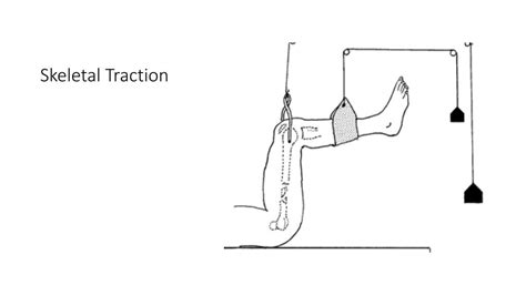Skeletal Traction