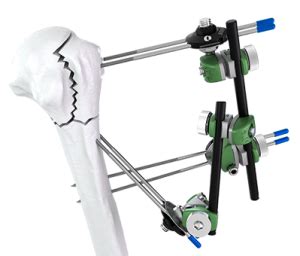 External Fixator Joint Components Orthofix Galaxy Fixation™