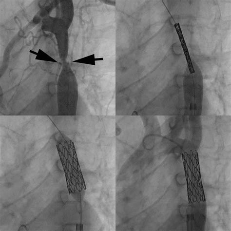 Heart Cath Procedure Anesthesia At Jo Mendes Blog