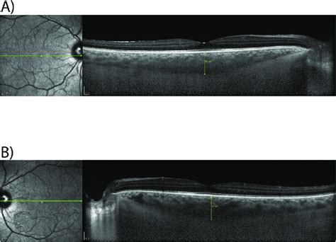enhanced depth imaging optic coherence tomography edi oct of the