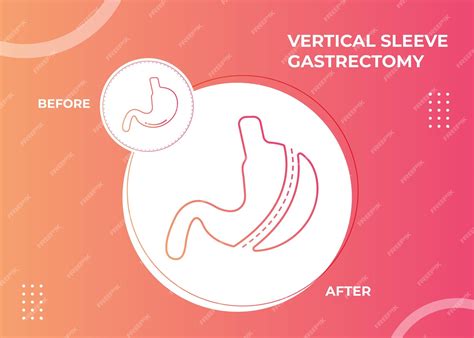 Premium Vector Laparoscopic Sleeve Gastrectomy Vertical Gastrectomy