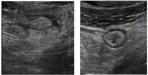 Ultrasound Diagnosis Of Primary Epiploic Appendagitis A Case Report