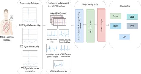 Figure 2 From Arrhythmia Classification Using Hybrid Cnn Lstm Model Semantic Scholar