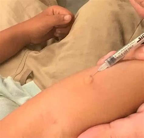 Mantoux Test Procedure Clinical Laboratory Guide