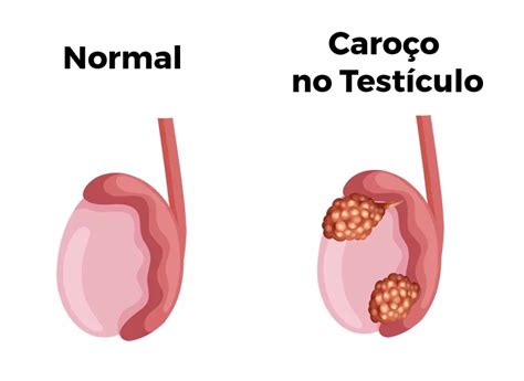 Caroco Do Epididimo Removedor Fungos Genital Hpv Caroço Anus Coceira