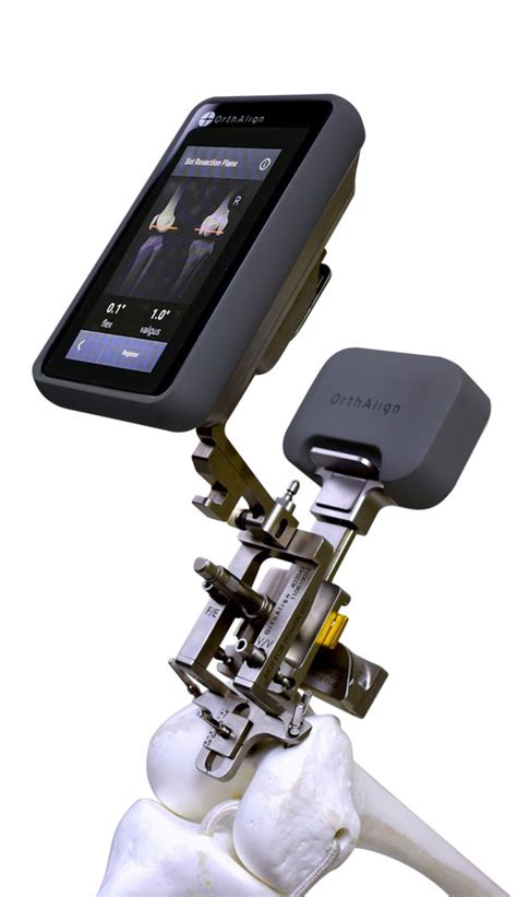Orthalign Inc Announces First Cases Using Lantern™ Surgical Assistant