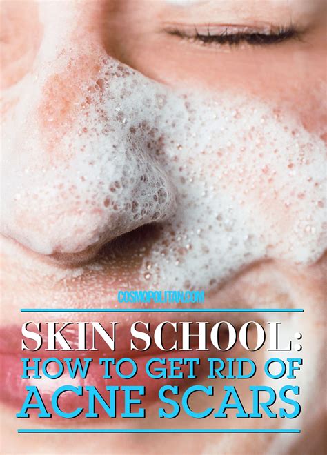 How To Get Rid Of Acne Scars 10 Products And Remedies To Try Artofit