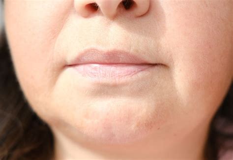 How To Tighten Sagging Skin Around The Mouth Without Surgery