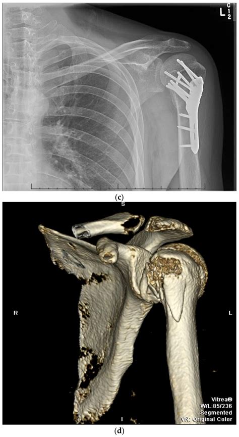 Comminuted Proximal Humerus Fracture Comminuted Proximal Humerus Fracture