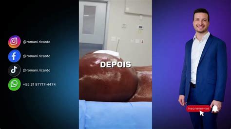 LipoaspiraÇÃo Lipoenxertia De GlÚteo Lipoescultura Youtube
