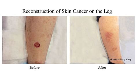 Full Thickness Skin Graft Donor Site Healing At Tina Kemp Blog
