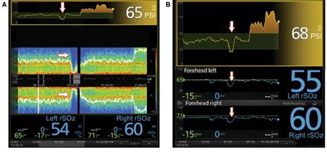 A Processed Electroencephalography Peeg Monitoring Using Two Download Scientific Diagram