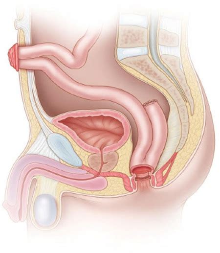 Current Status And Surgical Technique For Restorative Proctocolectomy