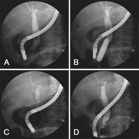 Fluoroscopic View Of Large Balloon Dilatation Without B Open I