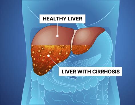 Cirrhosis Of The Liver Signs And Symptoms Causes Stages