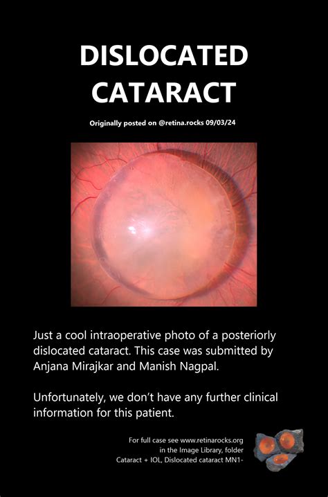 Miscellaneous Cataract Dislocated Iol Retained Lens Fragments