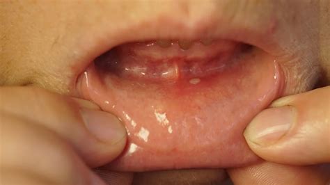 Medications That Can Cause Burning Mouth Syndrome And More Goodrx