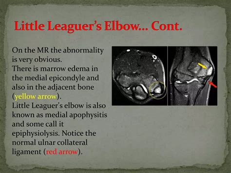 Elbow Mri Pptx