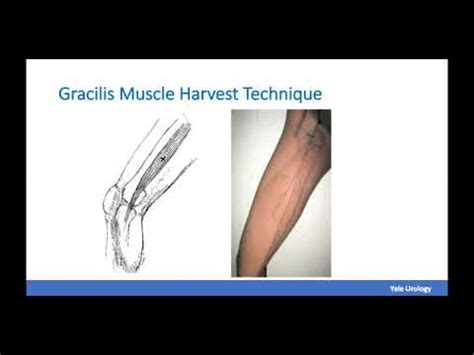 The Gracilis Muscle Flap Versatile Applications In Urology Youtube