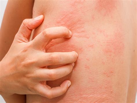What Is Chemo Rash Balmonds