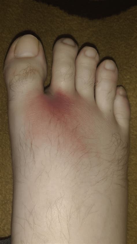 Foot Abscess Is By Far The Most Painful Thing Ive Ever Experienced R