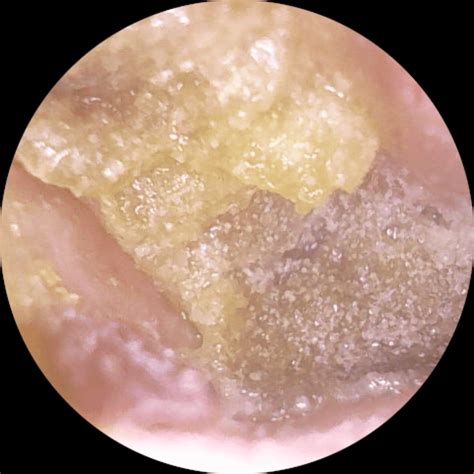Post Mastoidectomy Infection R Cholesteatoma