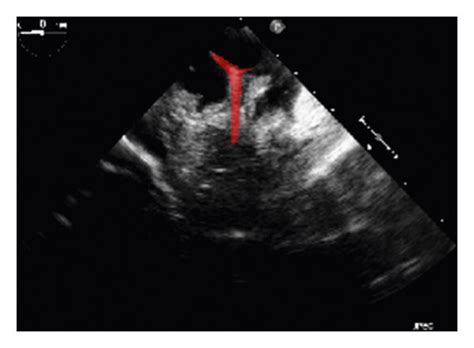 A Ground Truth Segmentation Of Shelley Medical Ablation Catheter B