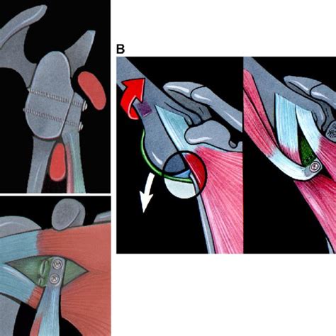 Postoperative Arthritis Samilson Prieto Classification A A