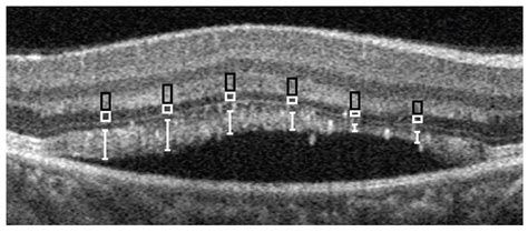 measurement of outer nuclear layer outer plexiform layer complex and