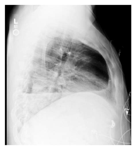 Chest X Ray On Representation Demonstrating Pyopneumothorax Download Scientific Diagram